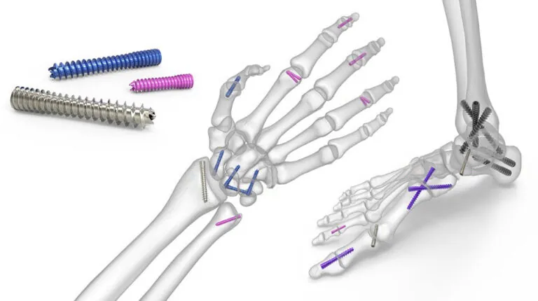 Acutrak 2 Headless Compression Screw System – Care Technology