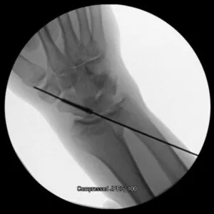Acutrak 2 Headless Compression Screw System - CARE TECH SOLUTIONS