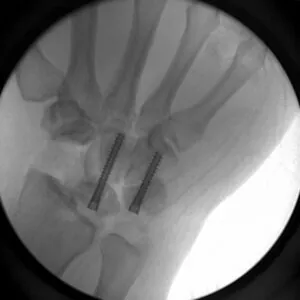 Acutrak 2 Headless Compression Screw System – Care Technology