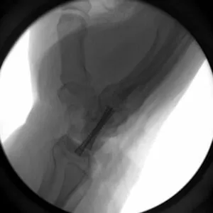 Acutrak 2 Headless Compression Screw System - CARE TECH SOLUTIONS