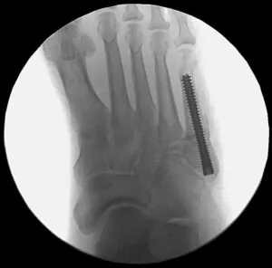 Acutrak 2 Headless Compression Screw System – Care Technology