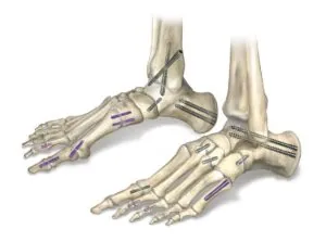 Acutrak 2 Headless Compression Screw System - CARE TECH SOLUTIONS