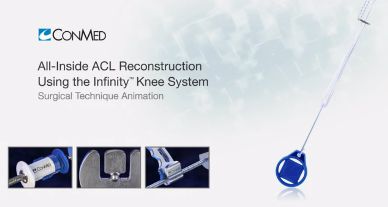 All-inside Acl Reconstruction Surgical Technique-orthopaedic Solutions – Care Technology