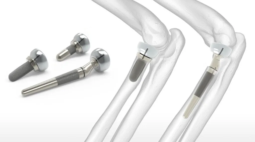 Anatomic Radial Head Solutions – Radial Head Replacement System - CARE ...