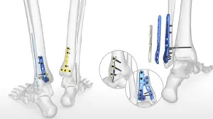 Ankle Plating System 3 – Fracture Plating Solutions Fixation Products ...