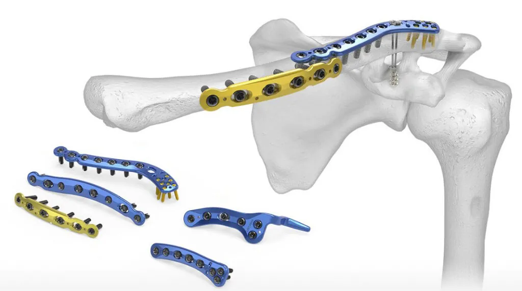 Clavicle Plating System – Fixation Products - CARE TECH SOLUTIONS