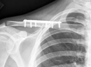 Clavicle Plating System – Fixation Products - CARE TECH SOLUTIONS