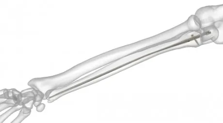 Forearm Fracture Solutions Hand Wrist – Fixation Products - CARE TECH ...