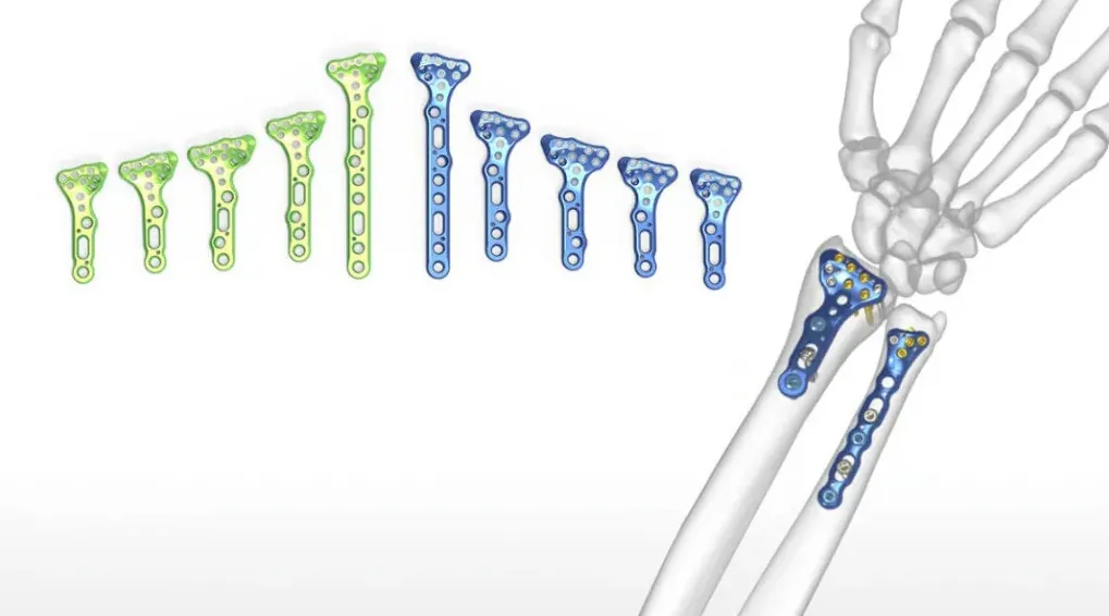 Hand & Wrist Acu-Loc 2 Wrist Plating System Acumed Distal Radius ...