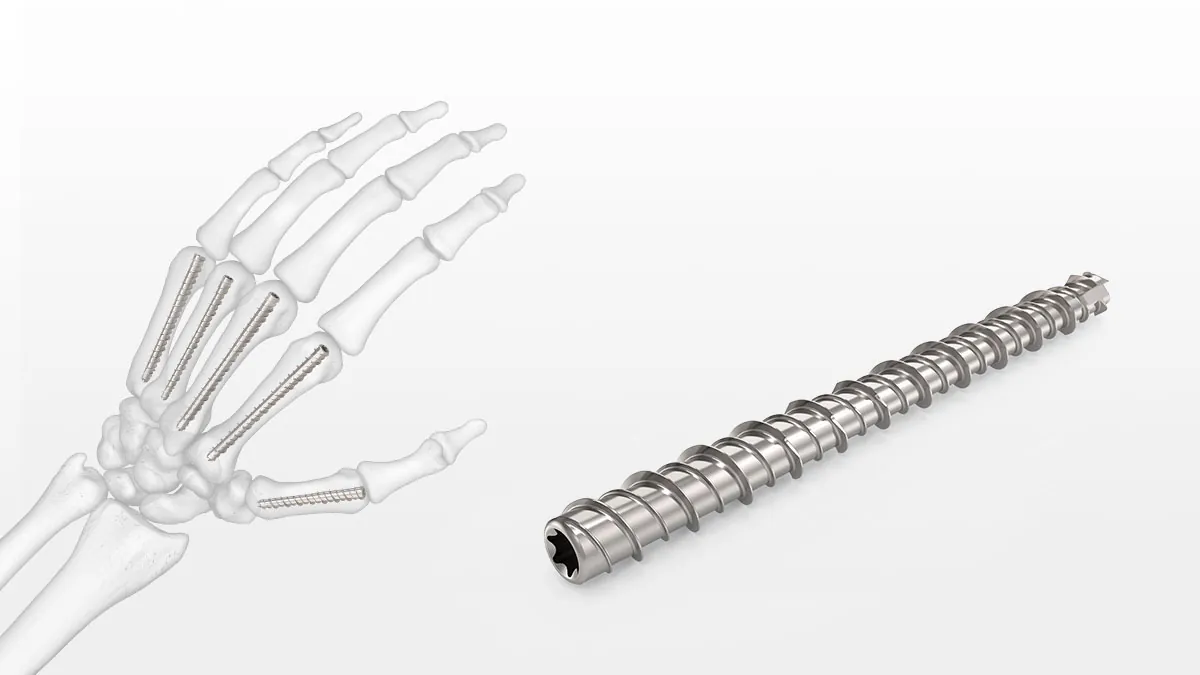 Hand-Wrist – INnate™ Intramedullary Threaded Nail System – Care Technology