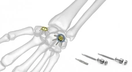 Hand & Wrist – Modular Hand System Metacarpal Bone Fusion System - Care ...