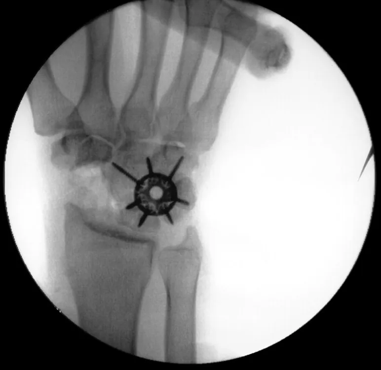 Hand & Wrist – Modular Hand System Metacarpal Bone Fusion System – Care ...