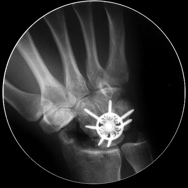Hand & Wrist – Modular Hand System Metacarpal Bone Fusion System - CARE ...