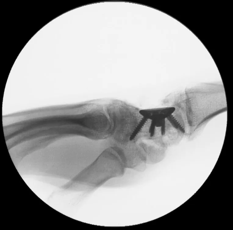 Hand & Wrist – Modular Hand System Metacarpal Bone Fusion System – Care ...