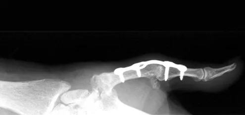Hand & Wrist – Modular Hand System Metacarpal Bone Fusion System - CARE ...