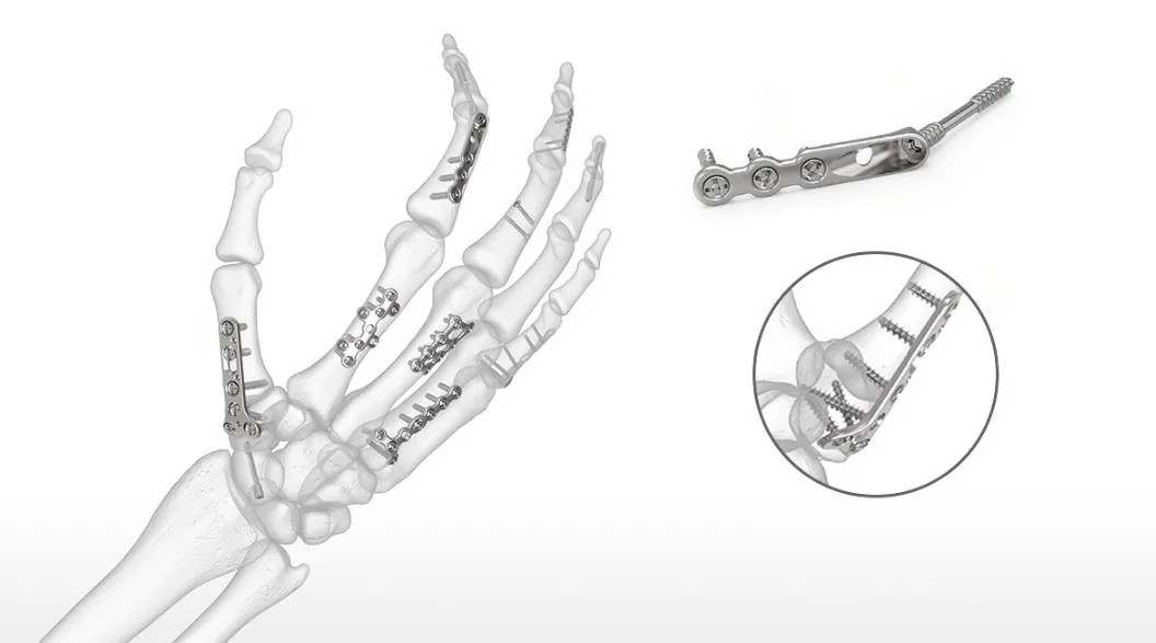 Hand & Wrist – OsteoMed Hand Fusion System (HPS) System Products - CARE ...