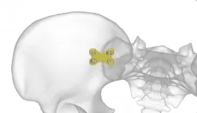 Pelvic Plating System Orthopaedic Solutions Fixation Products – Care ...