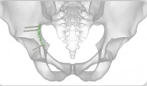 Pelvic Plating System Orthopaedic Solutions Fixation Products - CARE ...