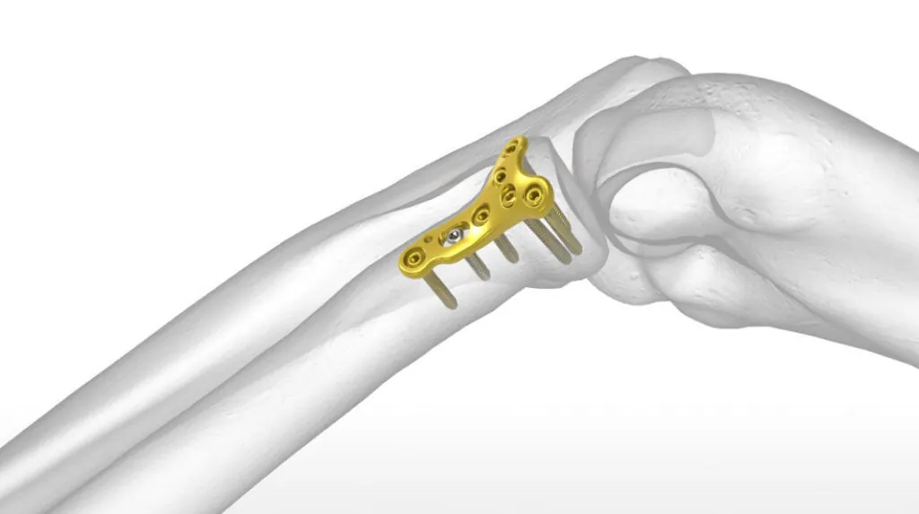 Radial Head Plating System Fixation Products – Care Technology