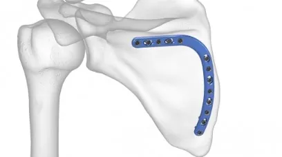 Scapula Plating System – Fixation Products - CARE TECH SOLUTIONS