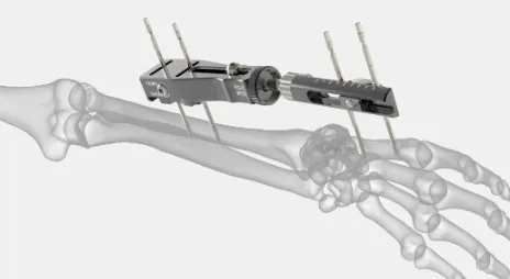StableLoc Ex Fix – Hand Wrist External Fixation System – Care Technology