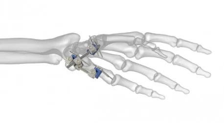 StableLoc Ex Fix – Hand Wrist External Fixation System – Care Technology