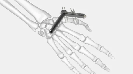 StableLoc Ex Fix – Hand Wrist External Fixation System – Care Technology