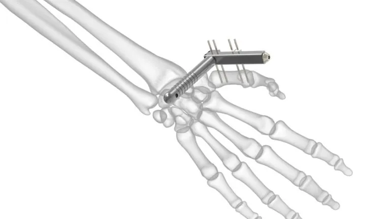 StableLoc Ex Fix – Hand Wrist External Fixation System - CARE TECH ...