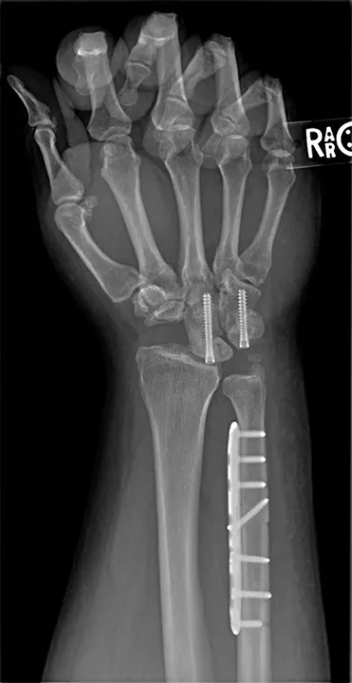 Ulna Osteotomy Hand Wrist – Ulna Osteotomy System - CARE TECH SOLUTIONS
