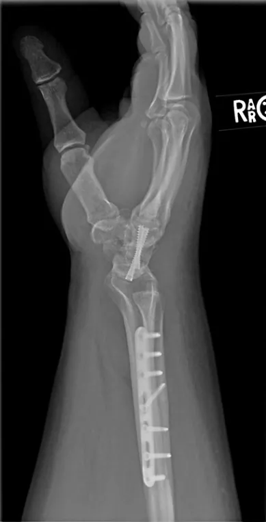 Ulna Osteotomy Hand Wrist – Ulna Osteotomy System - CARE TECH SOLUTIONS