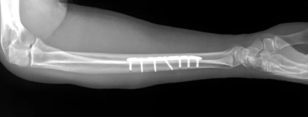 Ulna Osteotomy Hand Wrist – Ulna Osteotomy System - CARE TECH SOLUTIONS