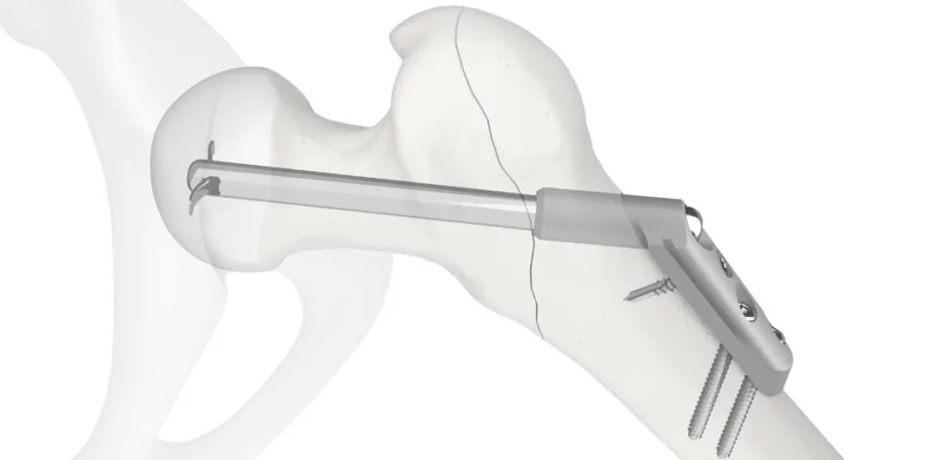 Hansson Twin Hook® With Twin Hook Locking Plate DHS-CHS- Femur Neck ...